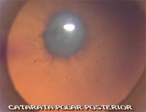 CATARATA POLAR POSTERIOR: técnica quirúrgica. - Vídeos
